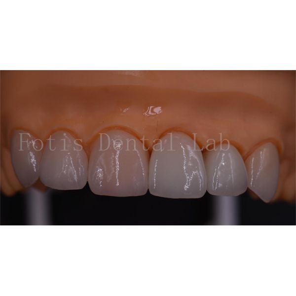 Quality 3 Shape Digital Crowns Good Compatibility Dentrues Design 1 Day Delivery for sale