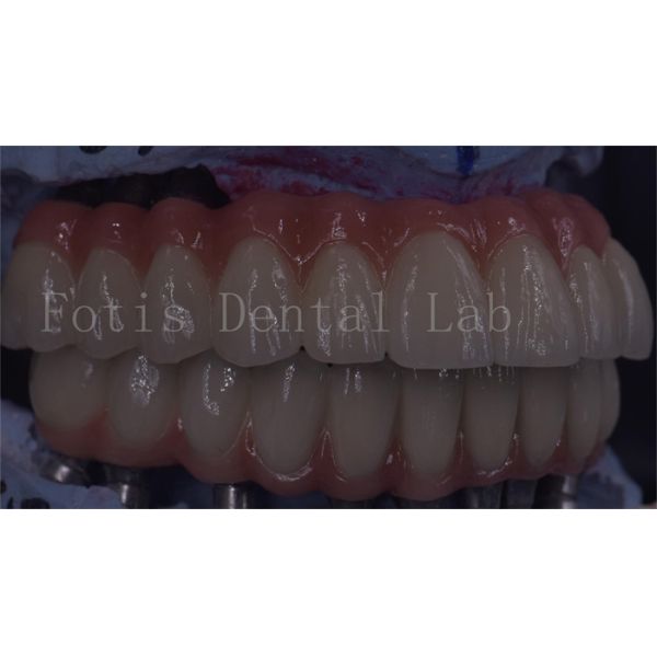 Quality OEM Service Durable Dental Implant Temporary Crown Easy Maintenance for sale