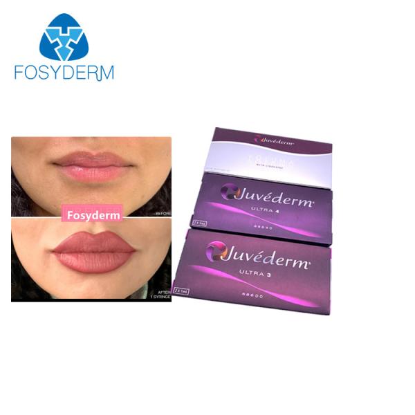 Quality Juvederm Ultra3 Lip Enhancement Hyaluronic Acid Dermal Filler 2x1.0ml for sale
