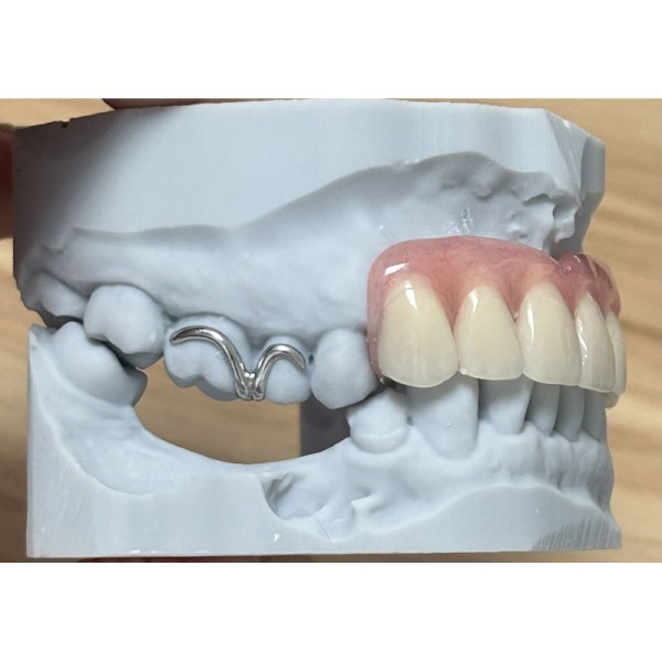 Quality Metal Framework with acrylic partial denture finish for sale