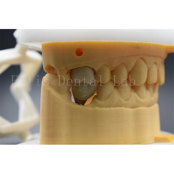 Quality Customizable Dental Implant Abutment Crown Comfortable For Patients for sale