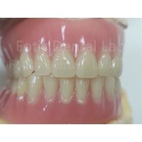 Quality Comfort Custom Fit Full Acrylic Denture For Precise Dental Prosthesis for sale