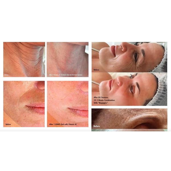 Quality LDM Dual Frequency Skin Care Machine Ultrasound Hydra Facial Rejuvenation for sale