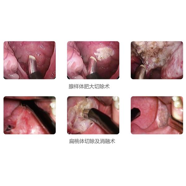 Quality Compact Cold Urology Coblation Plasma Surgery System Minimally Invasive for sale