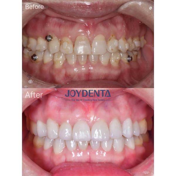 Quality Dental Veneers for Missing Teeth | Global Premium Dental Lab Services for sale