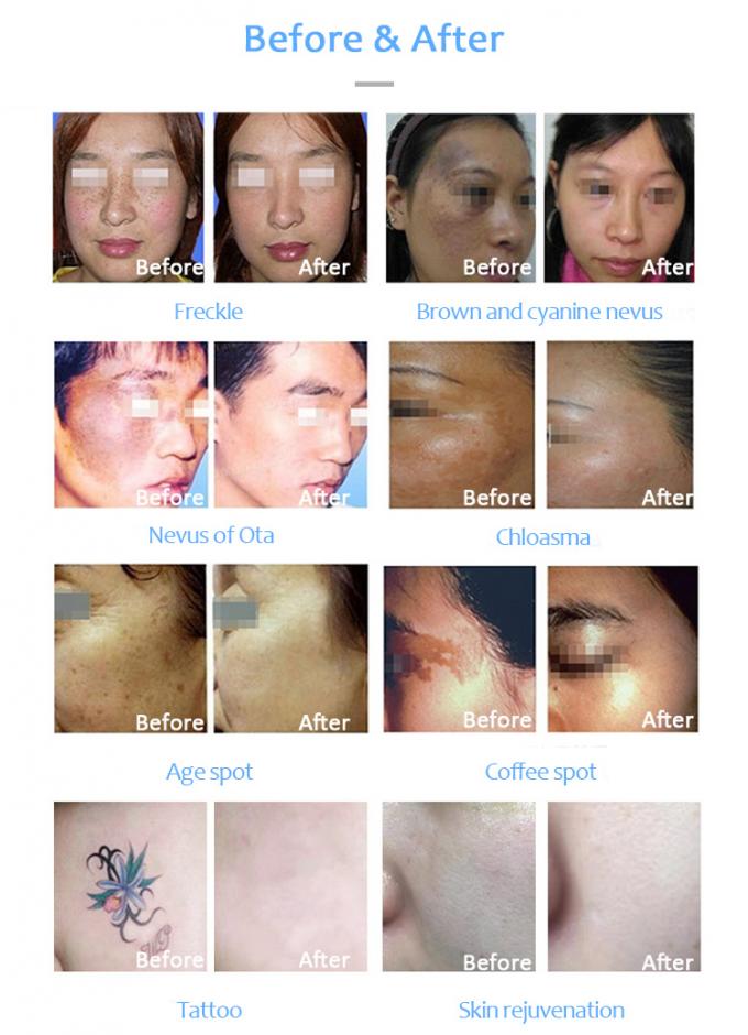 Uniform Spot 1064nm Pigmentation Removal and professional  tattoo removal Picosecond Laser Equipment 8