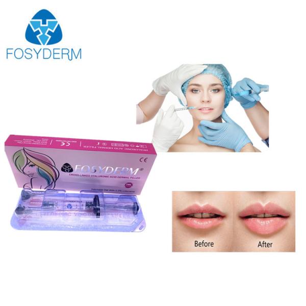 Quality Dermal Lip Fillers Anti Aging Lyft 1ml for sale
