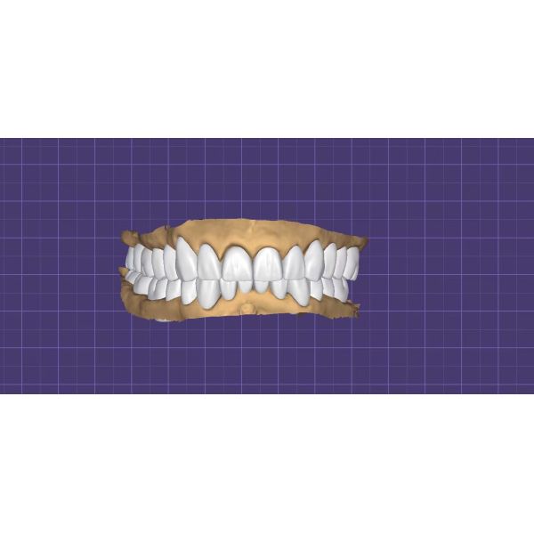 Quality Precision Fit Digital Wax Up Dental Study Model with Durable and Biocompatible for sale