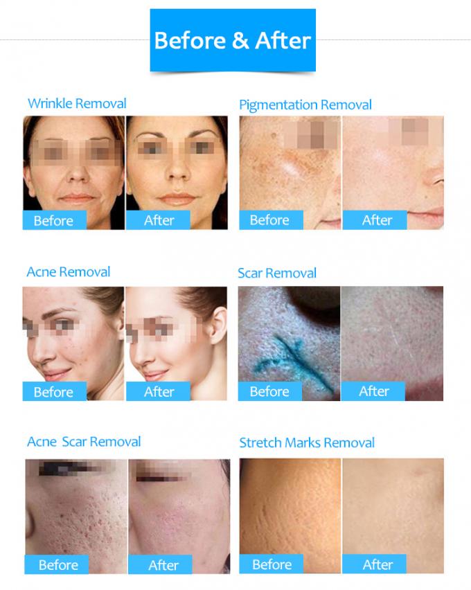 Honkon Medical CO2 Fractional Laser Stretch Mark Removal Large Pores Treatment Salon Machine 1