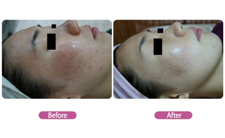 Hot new products for 2015 Skin renewing mahcine CO2 Fractional Laser