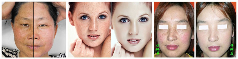 good quality fo ipl laser machine price