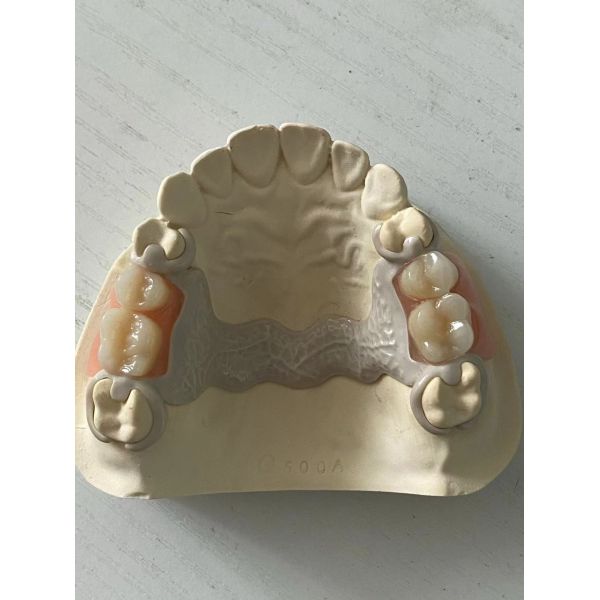 Quality Customized Dental PEEK Acrylic Partial Denture Adjustable With Secure Fit for sale