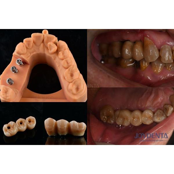 Quality Ultra Hard Colour Stability Dental Implant Crown OEM Easy Maintain Long Lasting for sale