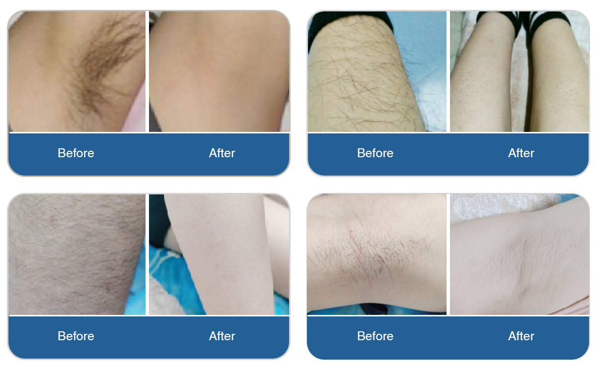 Vertical Triple Wavelength Diode Laser Hair Removal System