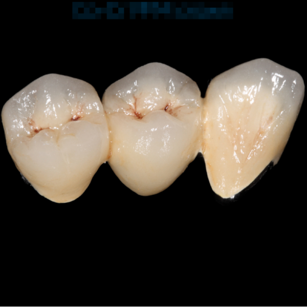 Quality Noble Precious Alloy Crown And Bridge Yellow Provisional Crown for sale