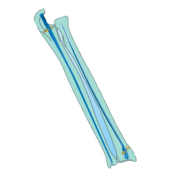 Quality Titanium Orthopedic Implant Intramedullary Nail System Tibial Approach for sale