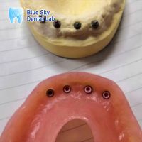 Quality Removable Implant Restoration Locator Implant Denture Full Mouth Restoration for sale
