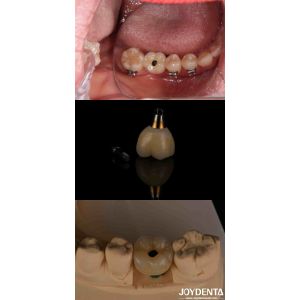 Quality 4-6 Dental Endosseous Tapered Implant Subcrestal Bone Level And Internal Hex for sale
