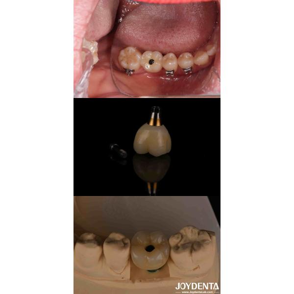 Quality 4-6 Dental Endosseous Tapered Implant Subcrestal Bone Level And Internal Hex Connection for sale