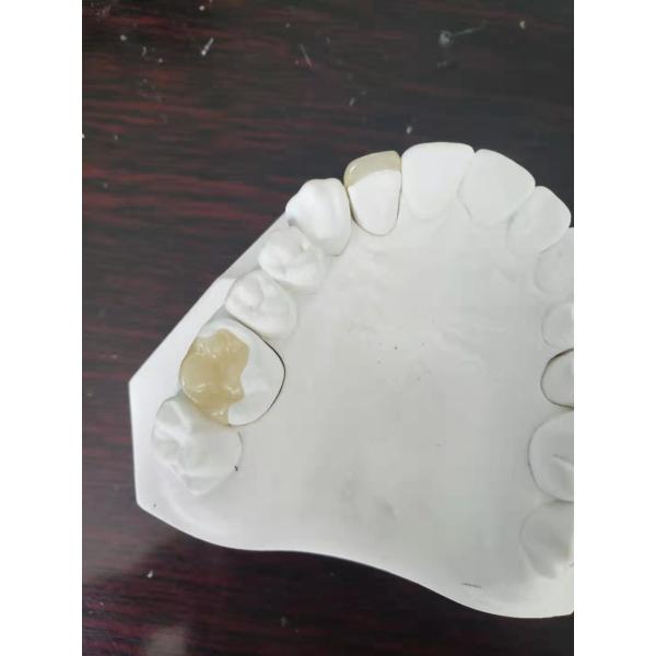 Quality Durable FDA All-Ceramic Dental Crown Veneer Inlay Onlay Similar for sale