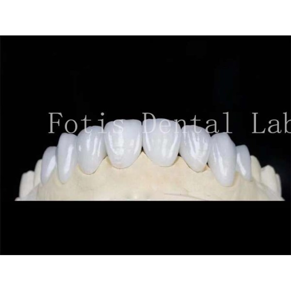 Quality Natural Color Dental Laminate Veneers Fake Teeth Veneers With Bonding Cement for sale