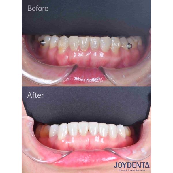 Quality Dental Veneers for Missing Teeth | Global Premium Dental Lab Services for sale