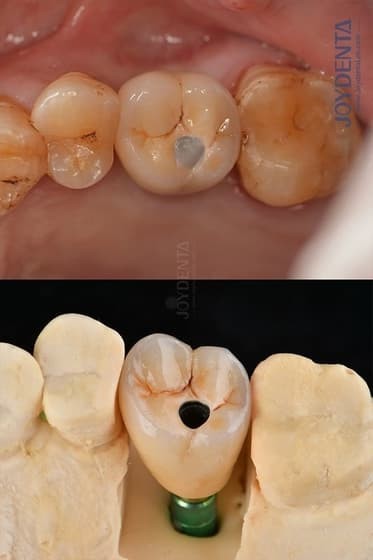Quality Titanium Full Arch Dental Implants Prosthetic Platform 4.1mm For Exceptional for sale