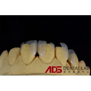Quality Dentures Aesthetic Emax All Ceramic Crowns Front Teeth OEM for sale