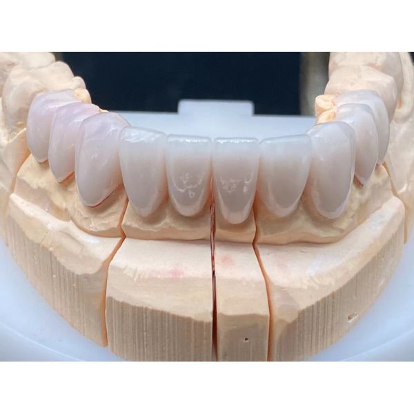 Quality Dental Lab E Max Ceramic Crown High Translucent with Corrosion Resistance for sale