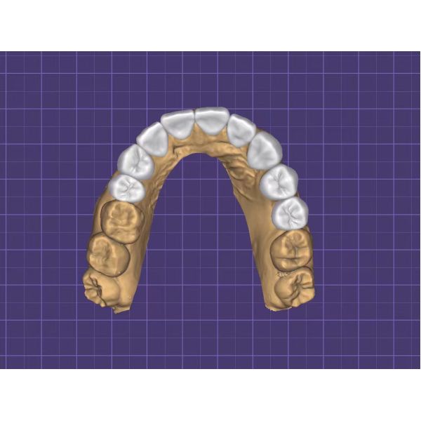 Quality Precision Fit Digital Wax Up Dental Study Model with Durable and Biocompatible for sale