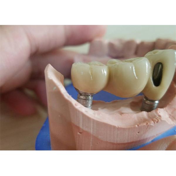 Quality CAD CAM Zirconia Dental Crown With Titanium Base Zirconia Abutment for sale