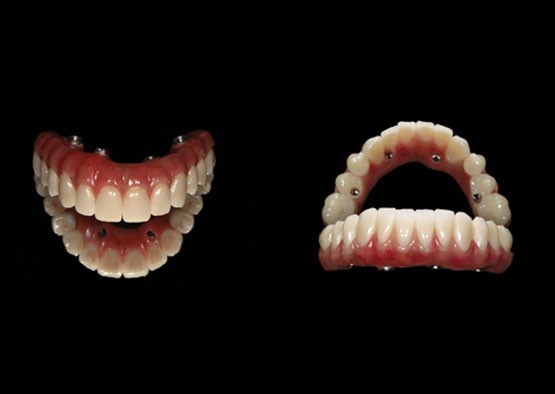 Implant restoration