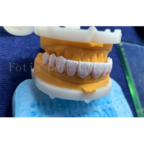 Quality Advanced Digital Dental Crowns Implant Dentrue Crown FDA/ISO/CE Certified for sale