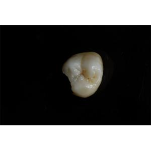Quality Customizable Ceramic Inlays And Onlays In Dentistry Restoration for sale