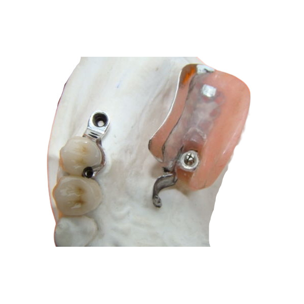 Quality Dental Lab Long Lasting Precision Attachment Denture Stain Resistant for sale