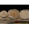 china Seamless Porcelain Emax Veneers Teeth Replacement Authentic Looking