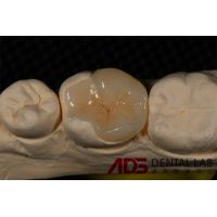 Quality Seamless Porcelain Emax Veneers Teeth Replacement Authentic Looking for sale