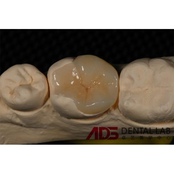 Quality Seamless Porcelain Emax Veneers Teeth Replacement Authentic Looking for sale