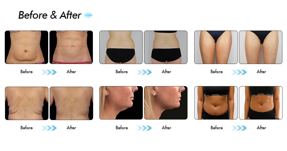 cryolipolysis fat freezing machine