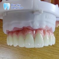 Quality Metal Frame Titanium Malo Bridge Customizable Malo Implant Bridge for sale