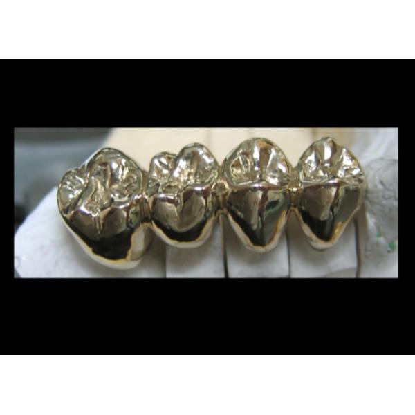 Quality High Stability Semi Precious Dental Crown Bridge PFM Easy Casting for sale