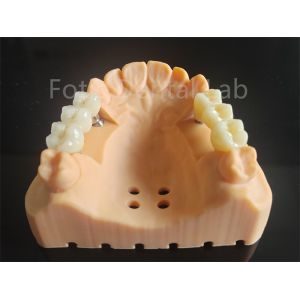 Quality Customized Full Contour Zirconia Layered With Porcelain Dental Material for sale