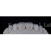 Quality Smooth Polished Ceramic Laminate Veneers In Dentistry Smile Creators for sale
