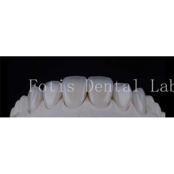 Quality Smooth Polished Ceramic Laminate Veneers In Dentistry Smile Creators for sale