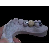 Quality Accurate White Long Lasting Maryland Bridge Dental Customizable For Restoration for sale
