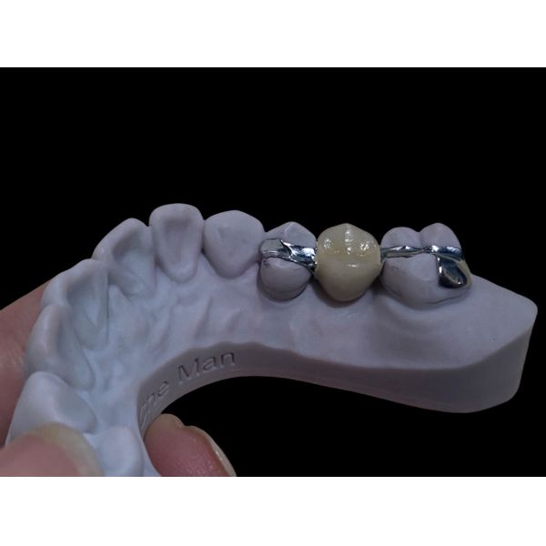 Quality Accurate White Long Lasting Maryland Bridge Dental Customizable For Restoration for sale