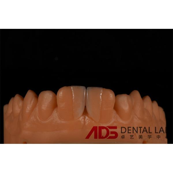 Quality Dentures Aesthetic Emax All Ceramic Crowns Front Teeth OEM for sale