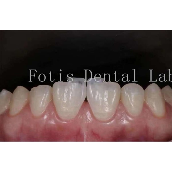 Quality Polishing Synthetic Dental Laminate Veneers High Stain Resistance for sale