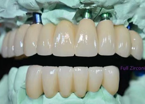 Quality OEM Implant Zirconia Dental Crown Fixed Bridge for sale