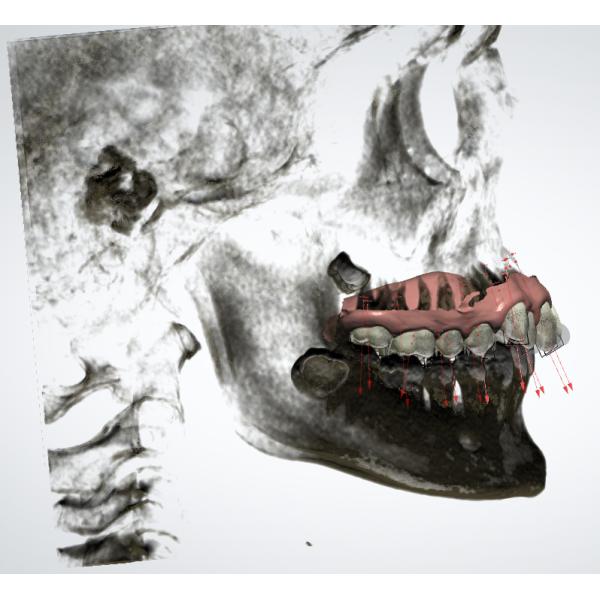 Quality Customized Rubber Fixed Orthodontic Appliances Easy Maintain for sale
